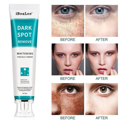 Freckle Removal Cream Effectively Fade Melasma Dark Spots Pigment ...